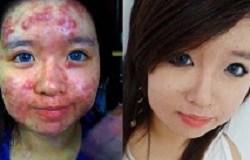 Sự thay đổi đến khó tin của cô gái từng bị mụn chi chít khắp mặt